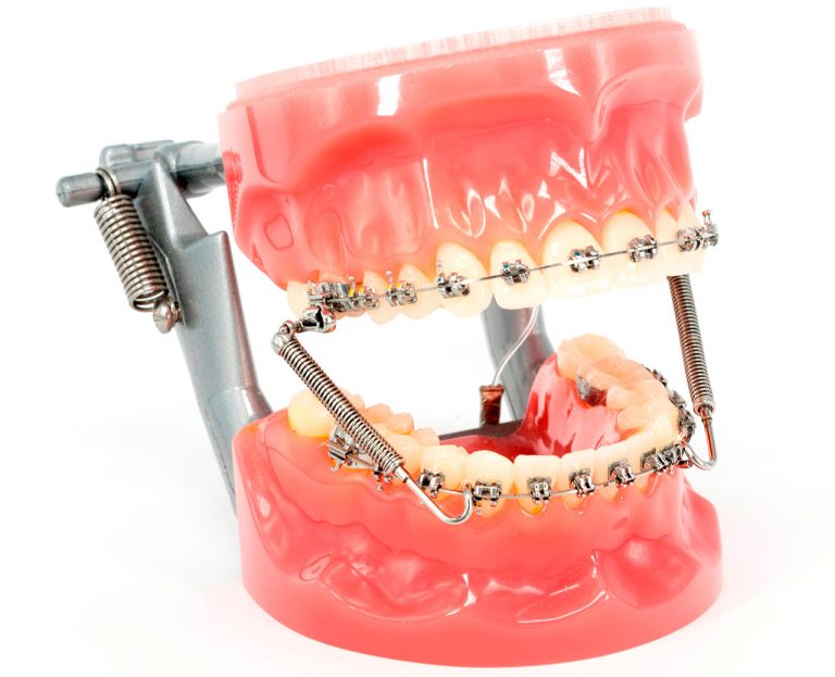 Vaste beugels | Orthodontisten Onderweg